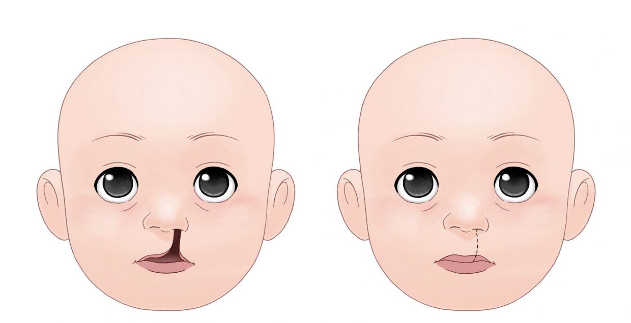 What is a Cleft Palate and Lip? - HealthMedline