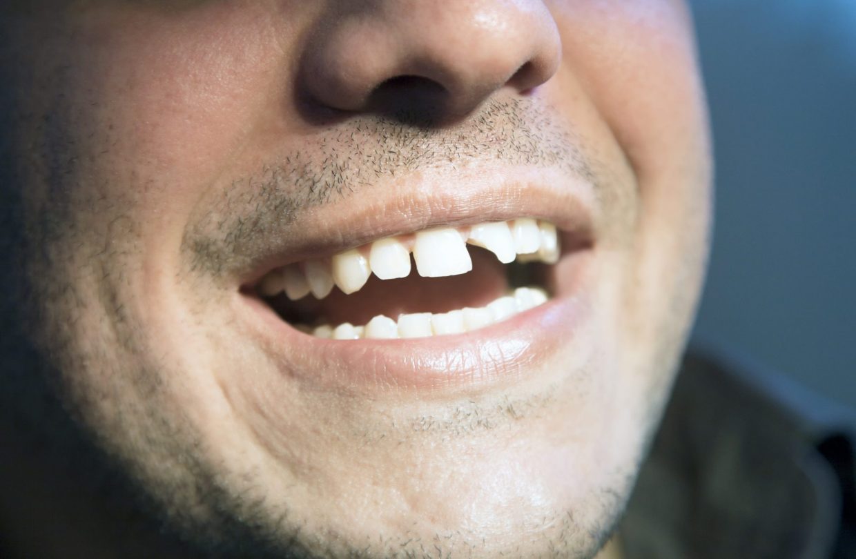 Chipped Tooth Repair - HealthMedline