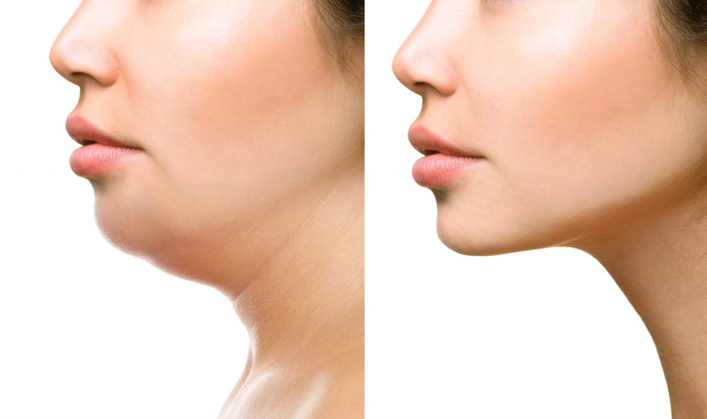 5 Things You Need to Know About Kybella Injections - HealthMedline